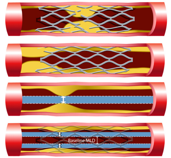 thrombosis Archives - SavingAdvice.com Blog